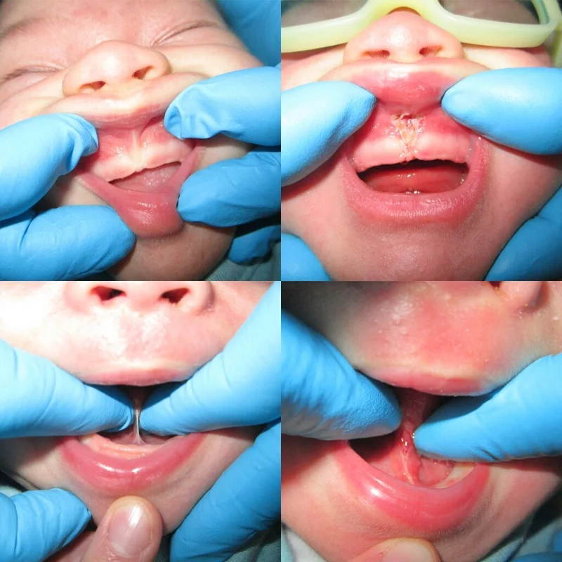 Tongue Tie and Upper Lip Tie — Tiny Sparks WA
