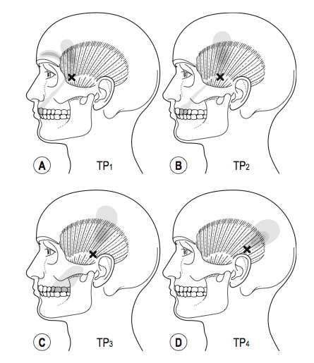 Temporomandibular Joint Disorders - Clinical Anatomy & Assessment ...