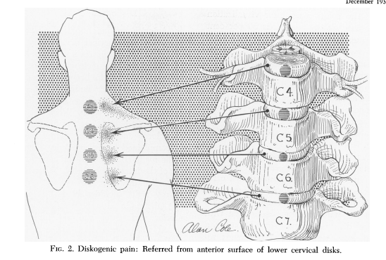 The Cloward Sign...cervical referral patterns — Rayner & Smale