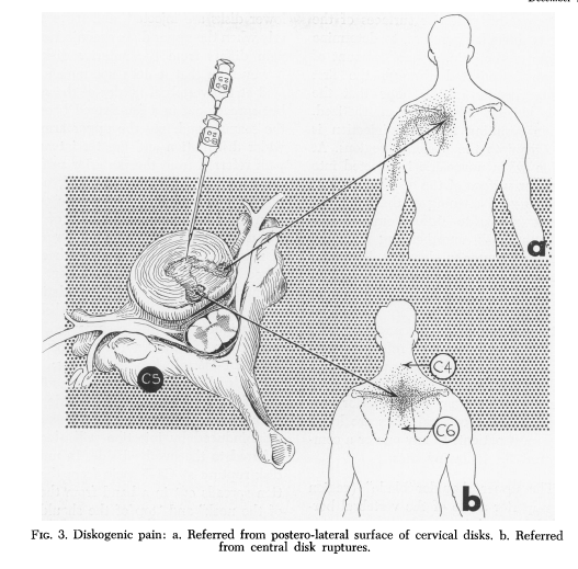 The Cloward Sign...cervical referral patterns — Rayner & Smale