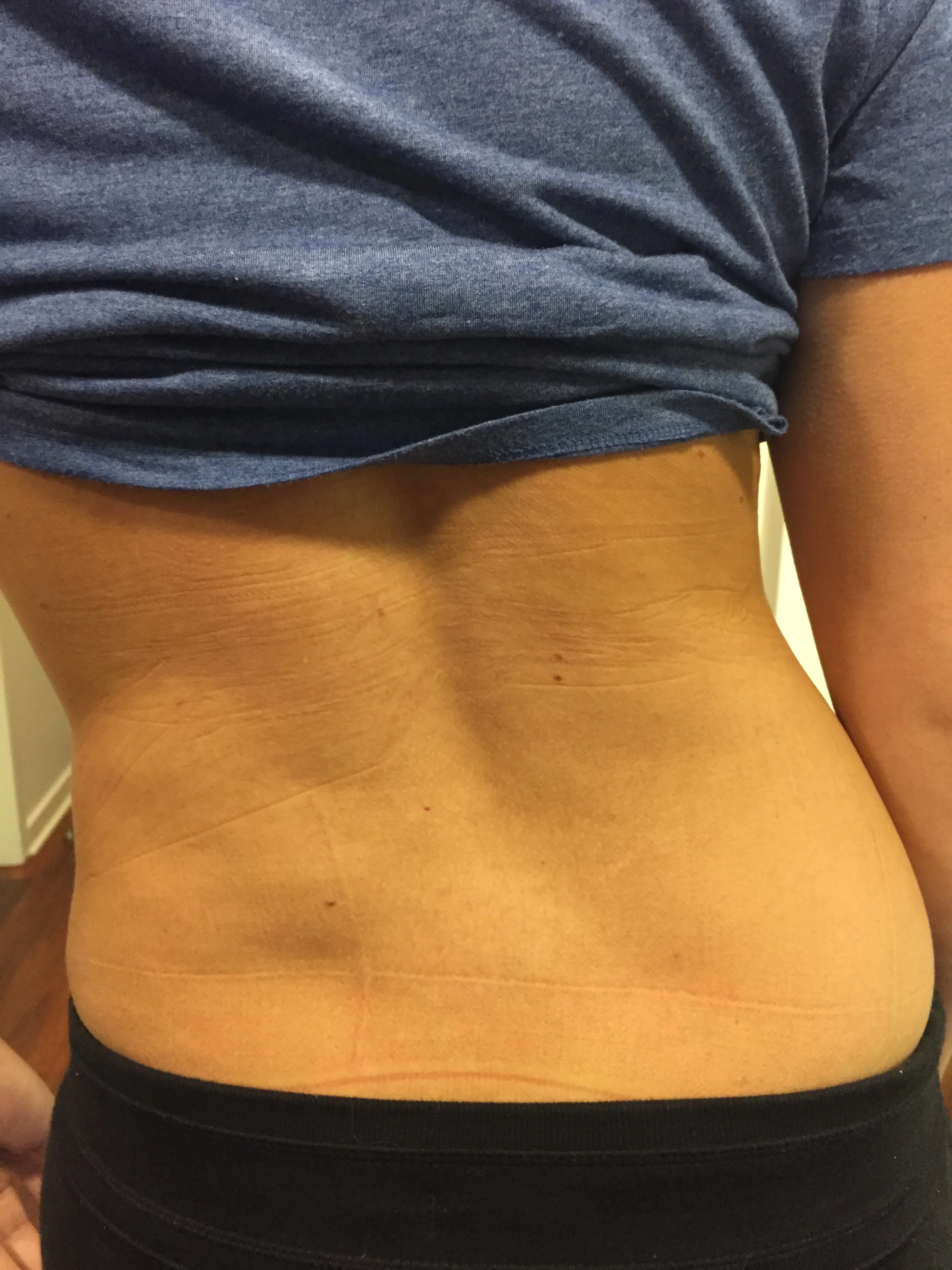 Lumbar Disc Herniation With Radiculopathy A Case Study Rayner Smale lumbar-disc-herniation-with-radiculopathy-a-case-study-rayner-smale