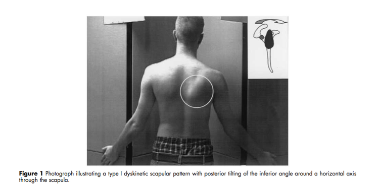The role of the scapula in Shoulder Impingement Syndrome: part 2 ...