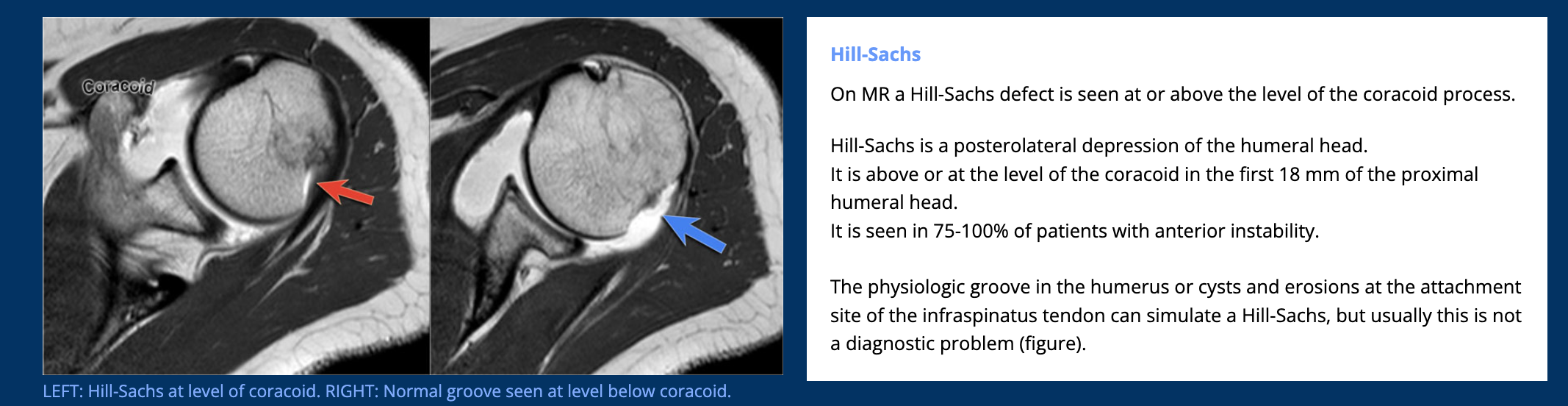 Bankart Lesion Mri Remplissage Austin, TX | Shoulder Arthroscopic