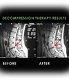 Decompression Therapy — Pura Vida Wellness Center