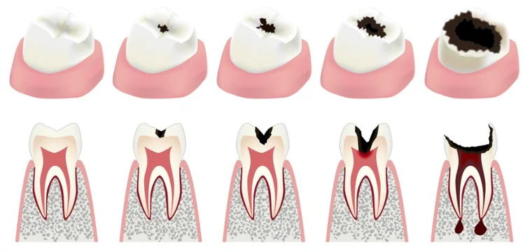 What Causes Cavities?
