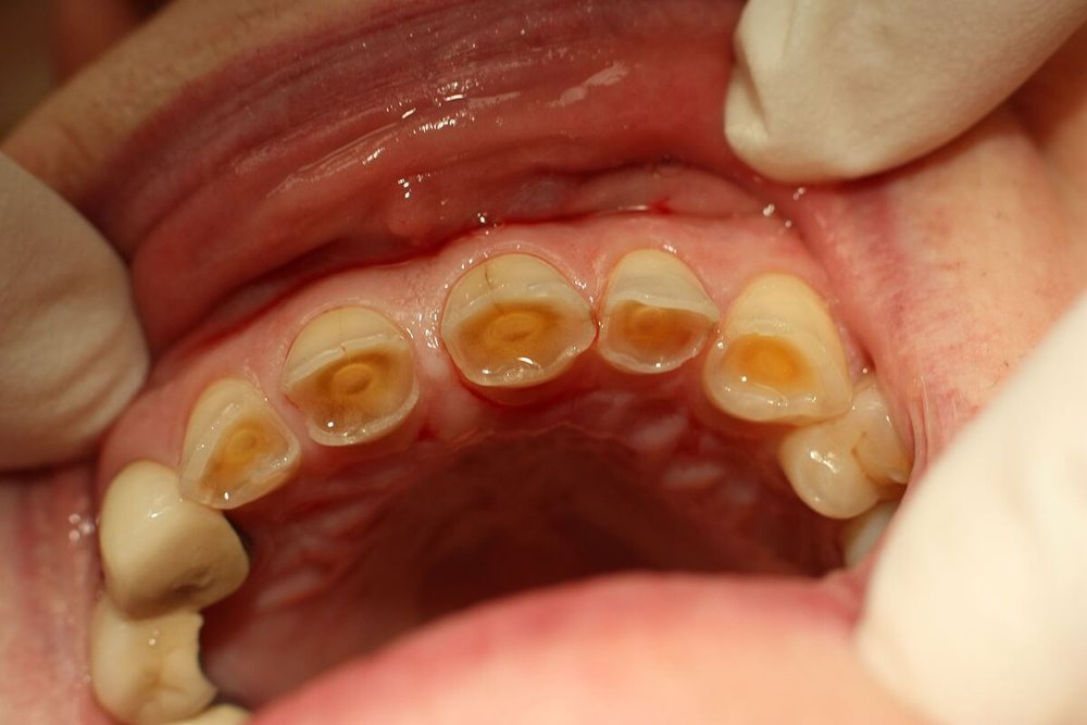 Should I Be Worried about my Worn Teeth?