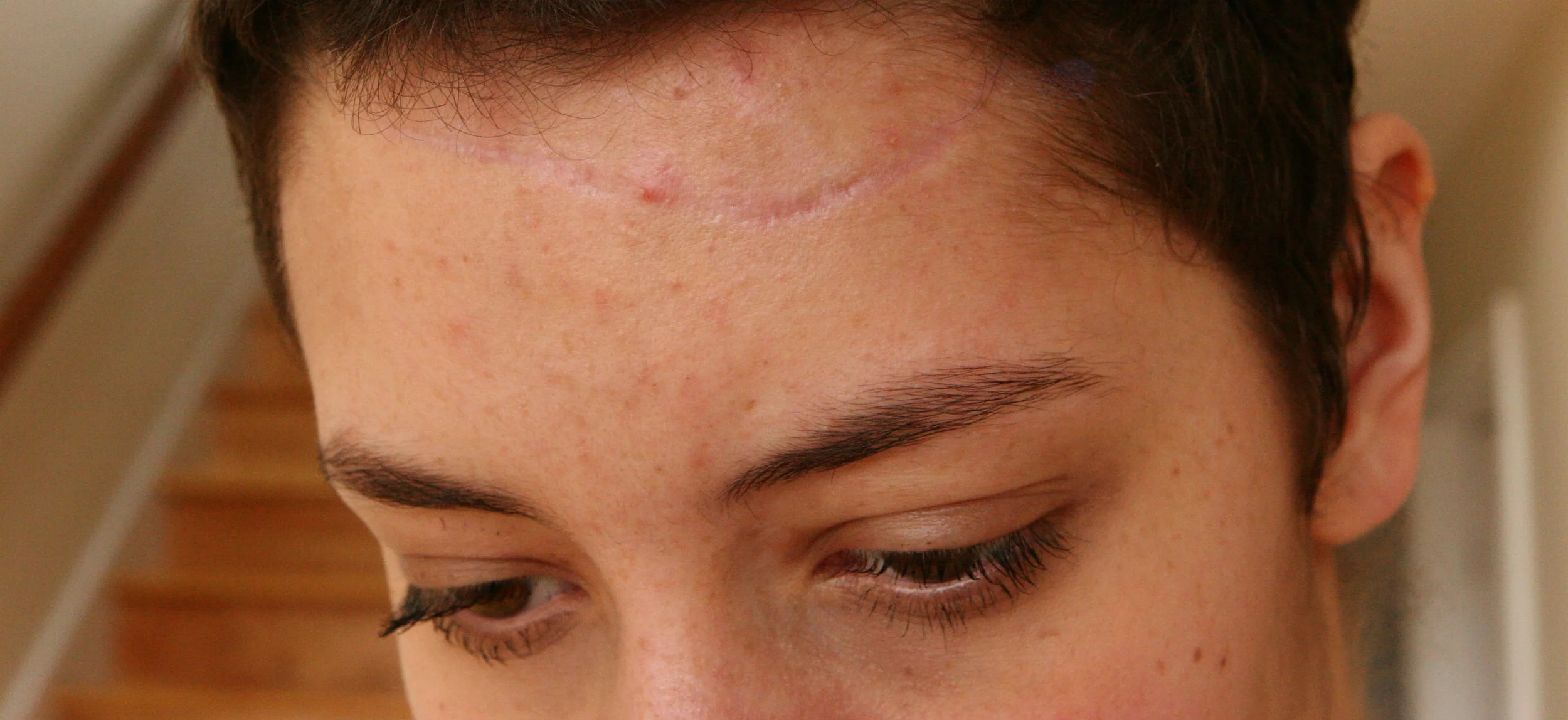 Laser Scar Resurfacing with Cap Aesthetics - Whole Healthy Mama ...