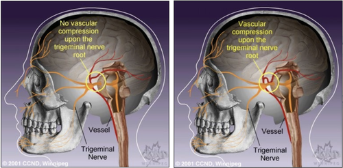 NeuWrite West -- The role of glia and immune cells in trigeminal nerve pain