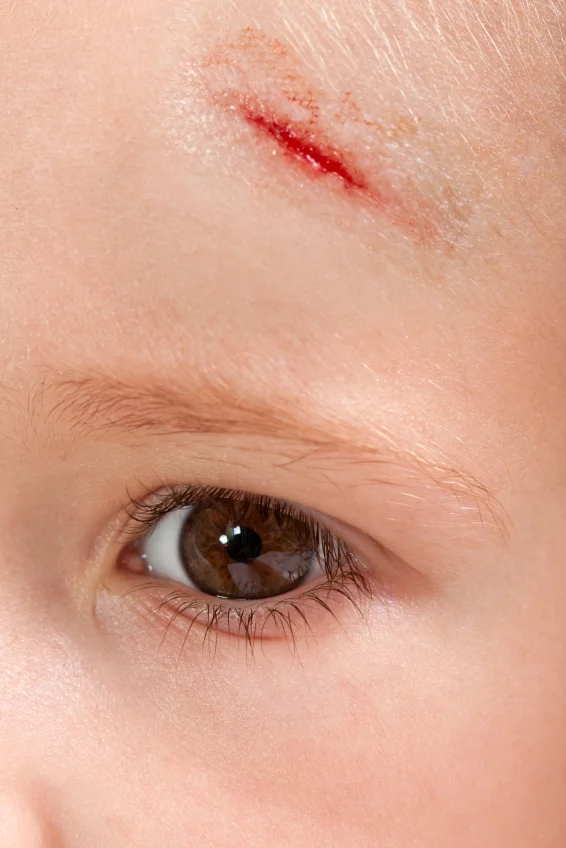 Cuts And Scrapes Trailhead Pediatrics
