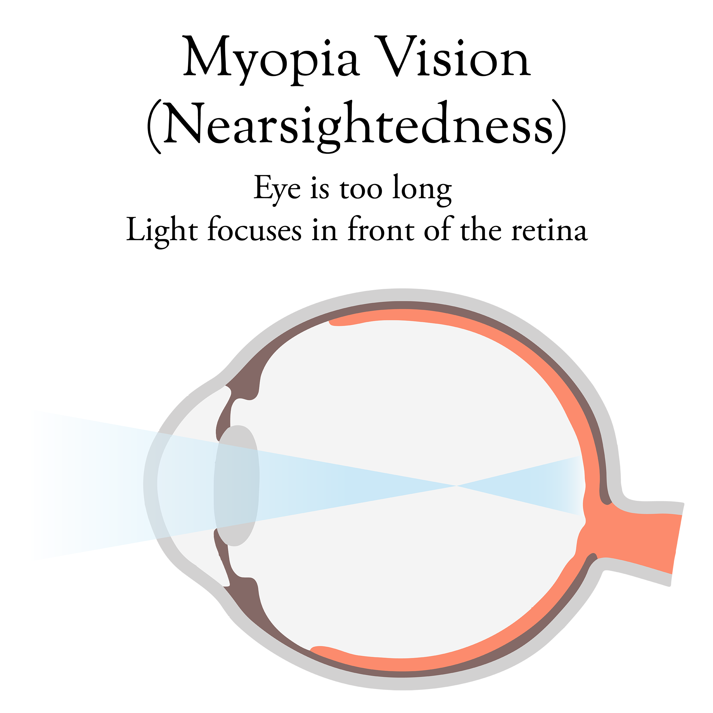 Myopia Clinic — Sylvan Family Eyecare