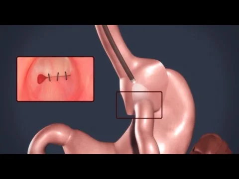 Weight Loss - Bariatric Endoscopy — Dr. Austin Chiang, MD MPH FACG FASGE