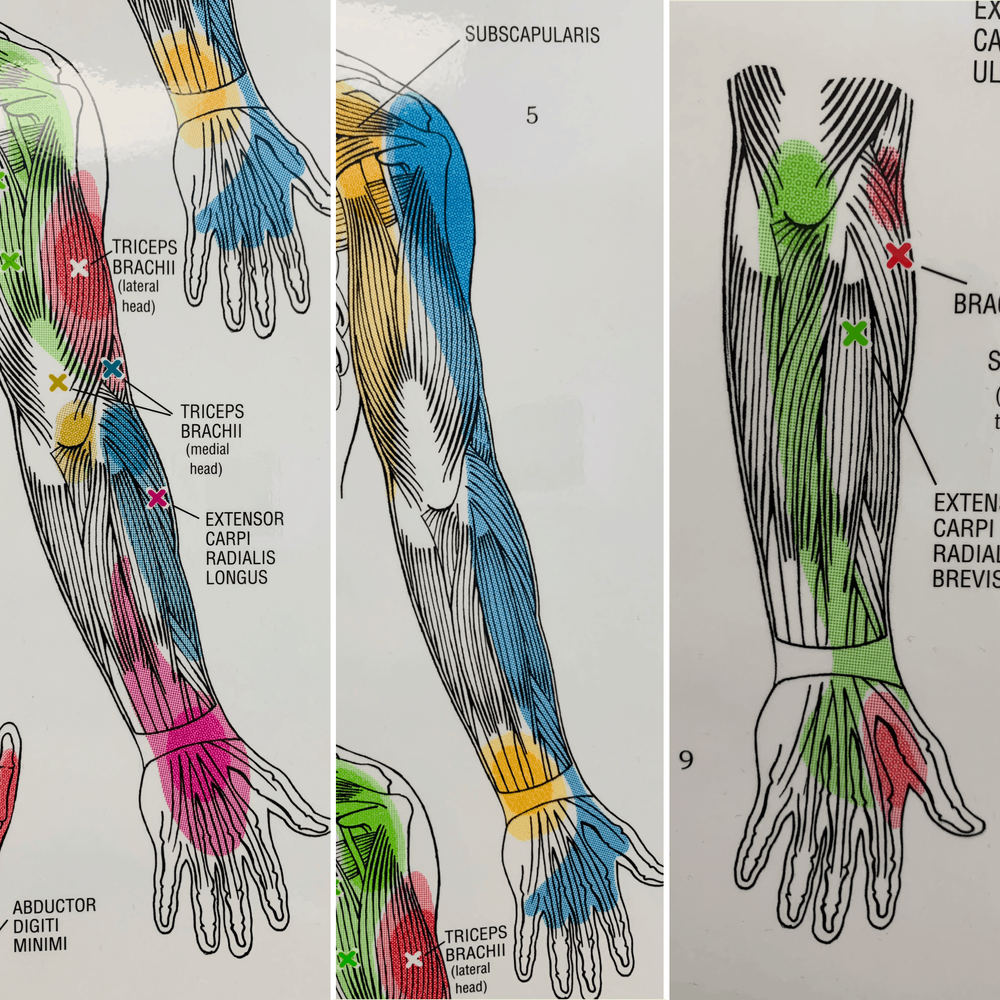 Tennis Elbow: Fast Track Your Healing — Kinfolk Physiotherapy & Wellness