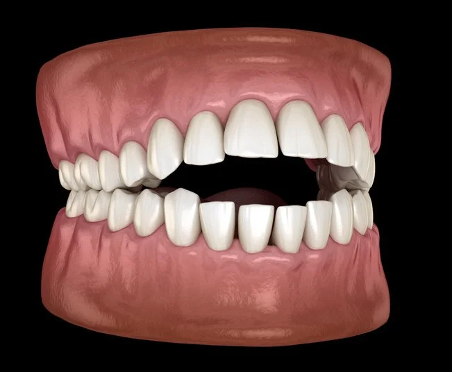 Understanding Anterior Open Bites: Causes, Effects, and Treatment ...