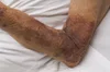 When Skin Becomes Fragile: Understanding Dermatoporosis — Dr. Scott ...