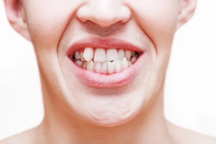 Lip Incompetence, Mouth Breathing, (And Mouth Tape?) — Dr. Scott Solomons