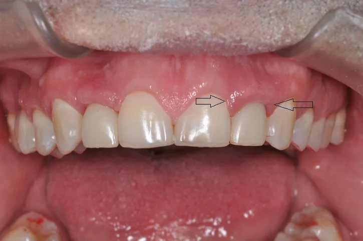 Swollen Gums And Diet — Dr. Scott Solomons