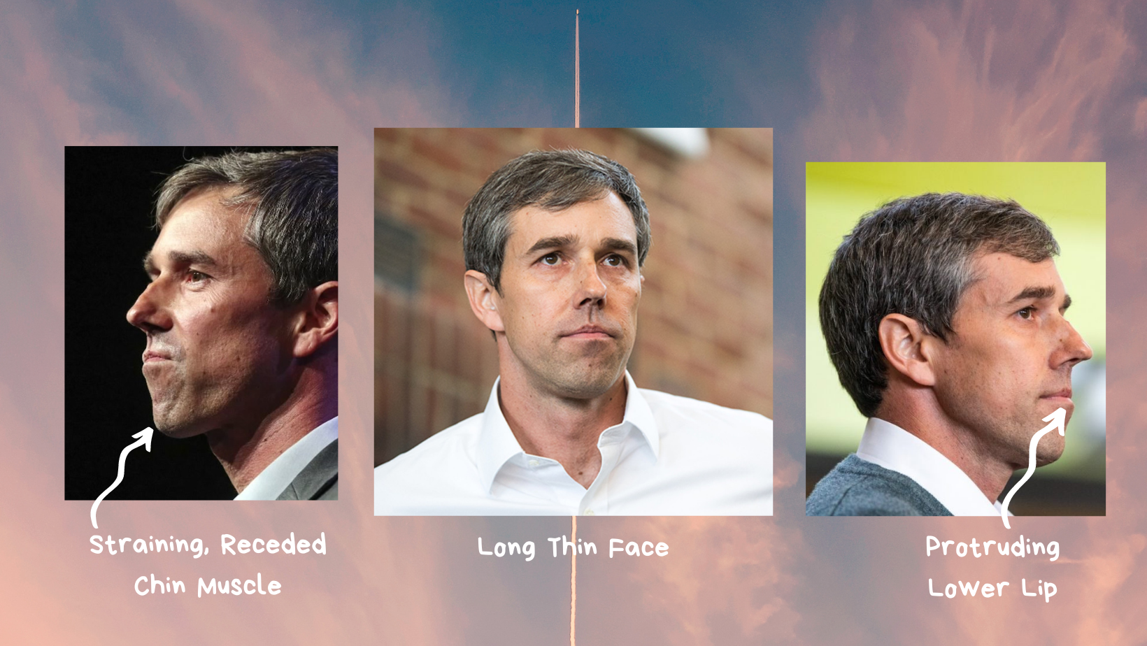 Lip Incompetence Revisited: Some Good News — Dr. Scott Solomons