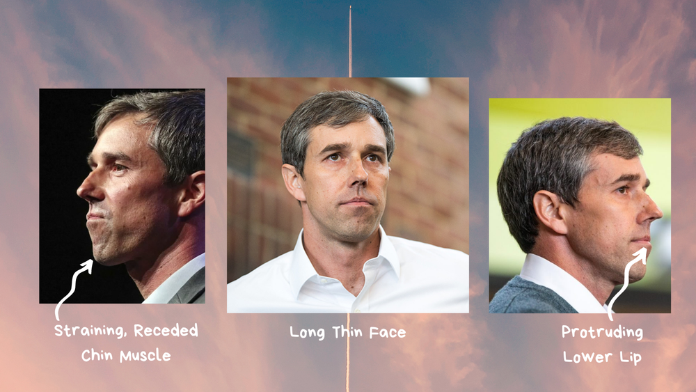 Lip Incompetence Revisited: Some Good News — Dr. Scott Solomons