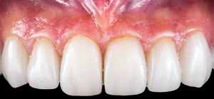 What is a Frenum, and Why It Can Sometimes Cause Big Problems — Dr ...