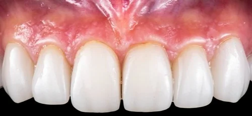 What is a Frenum, and Why It Can Sometimes Cause Big Problems — Dr ...