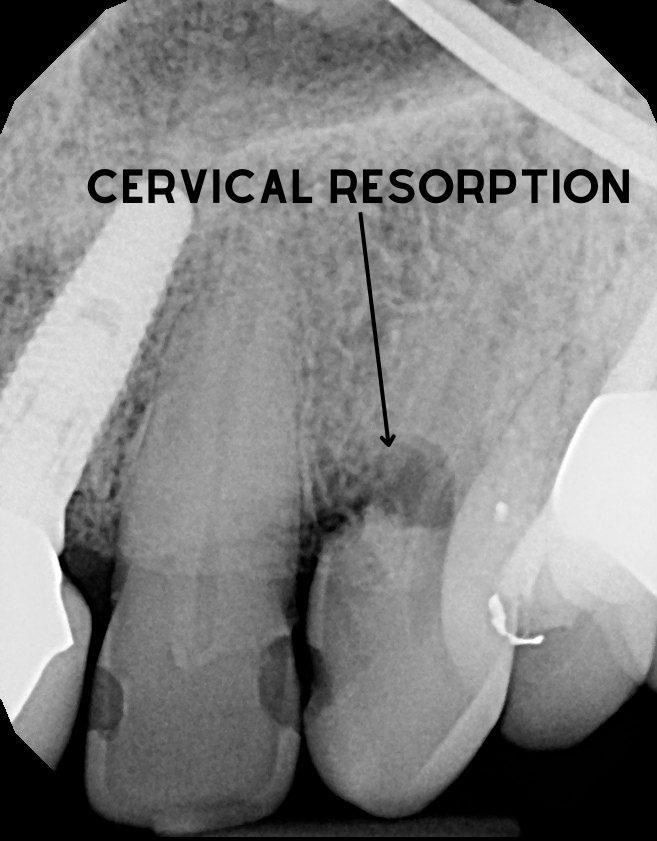 What Is Root Resorption? — Dr. Scott Solomons