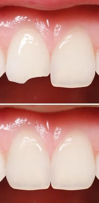 The Heartache of Bonded Front Teeth — Dr. Scott Solomons