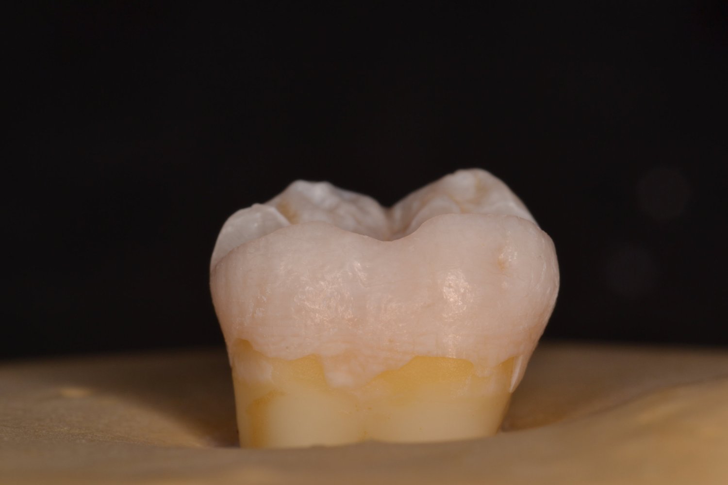 eMax Preparation Guidelines for Posterior Teeth-Renstrom Dental Studio ...