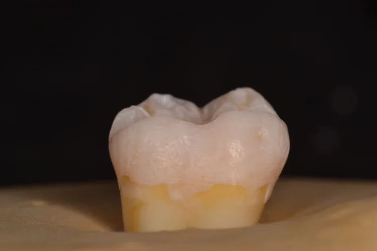 eMax Preparation Guidelines for Posterior Teeth-Renstrom Dental Studio ...