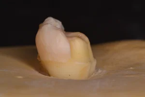 eMax Preparation Guidelines for Posterior Teeth-Renstrom Dental Studio ...