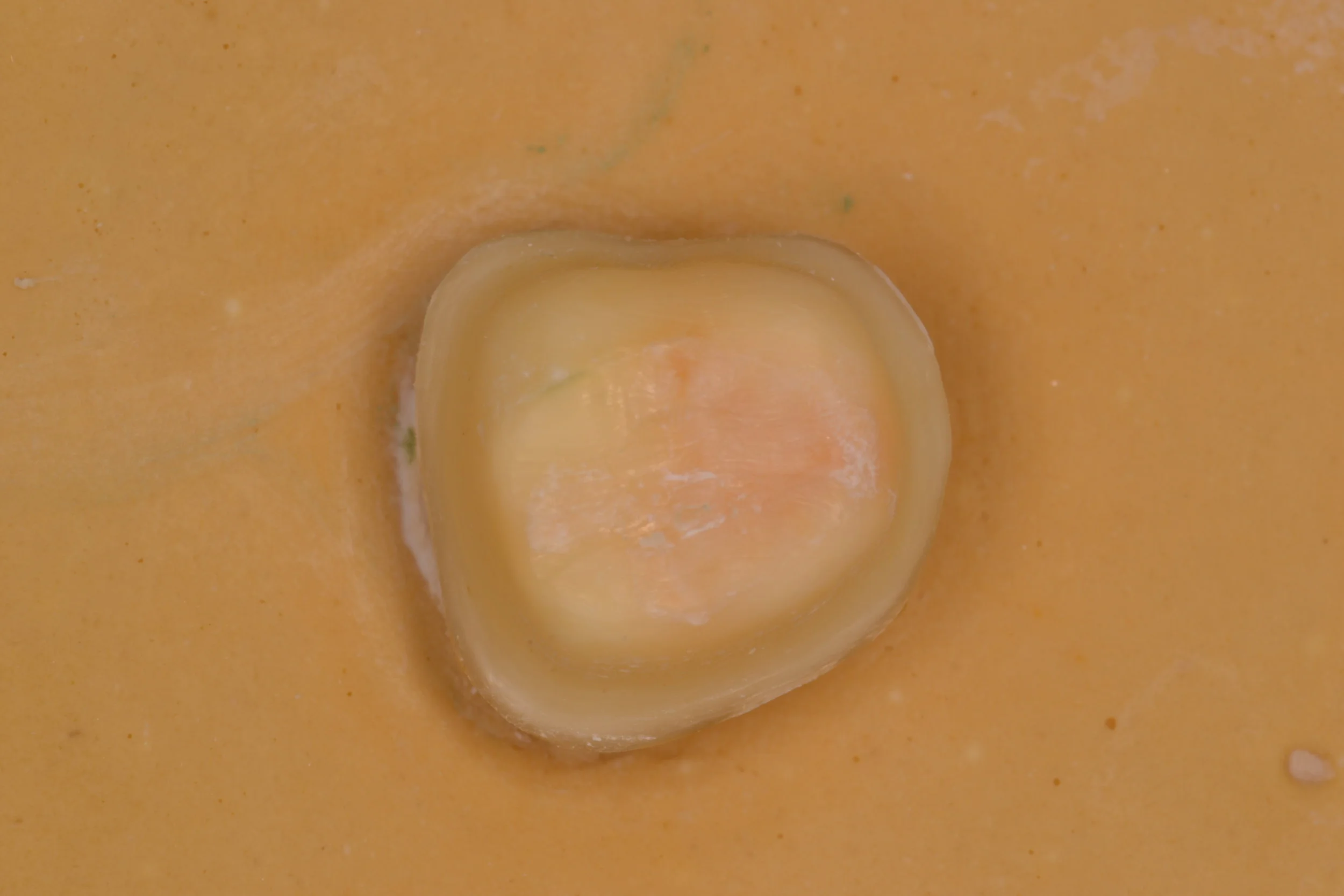 eMax Preparation Guidelines for Posterior Teeth-Renstrom Dental Studio ...