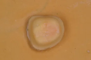 eMax Preparation Guidelines for Posterior Teeth-Renstrom Dental Studio ...