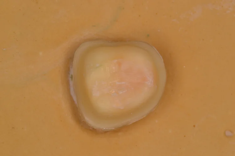 eMax Preparation Guidelines for Posterior Teeth-Renstrom Dental Studio ...