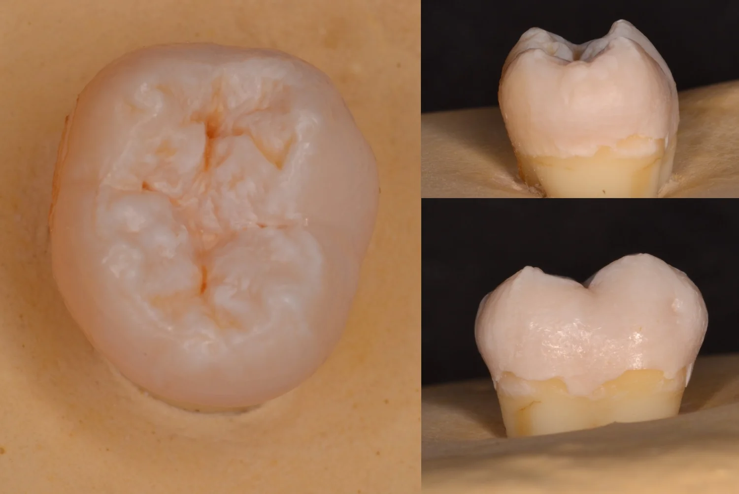 eMax Preparation Guidelines for Posterior Teeth-Renstrom Dental Studio ...
