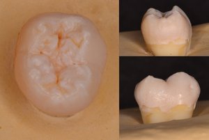 eMax Preparation Guidelines for Posterior Teeth-Renstrom Dental Studio ...