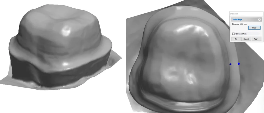 eMax Preparation Guidelines for Posterior Teeth-Renstrom Dental Studio ...