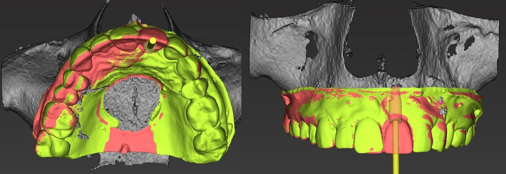 Anterior Implant Placement and the 3:2 Rule-RENSTROM DENTAL STUDIO, INC ...