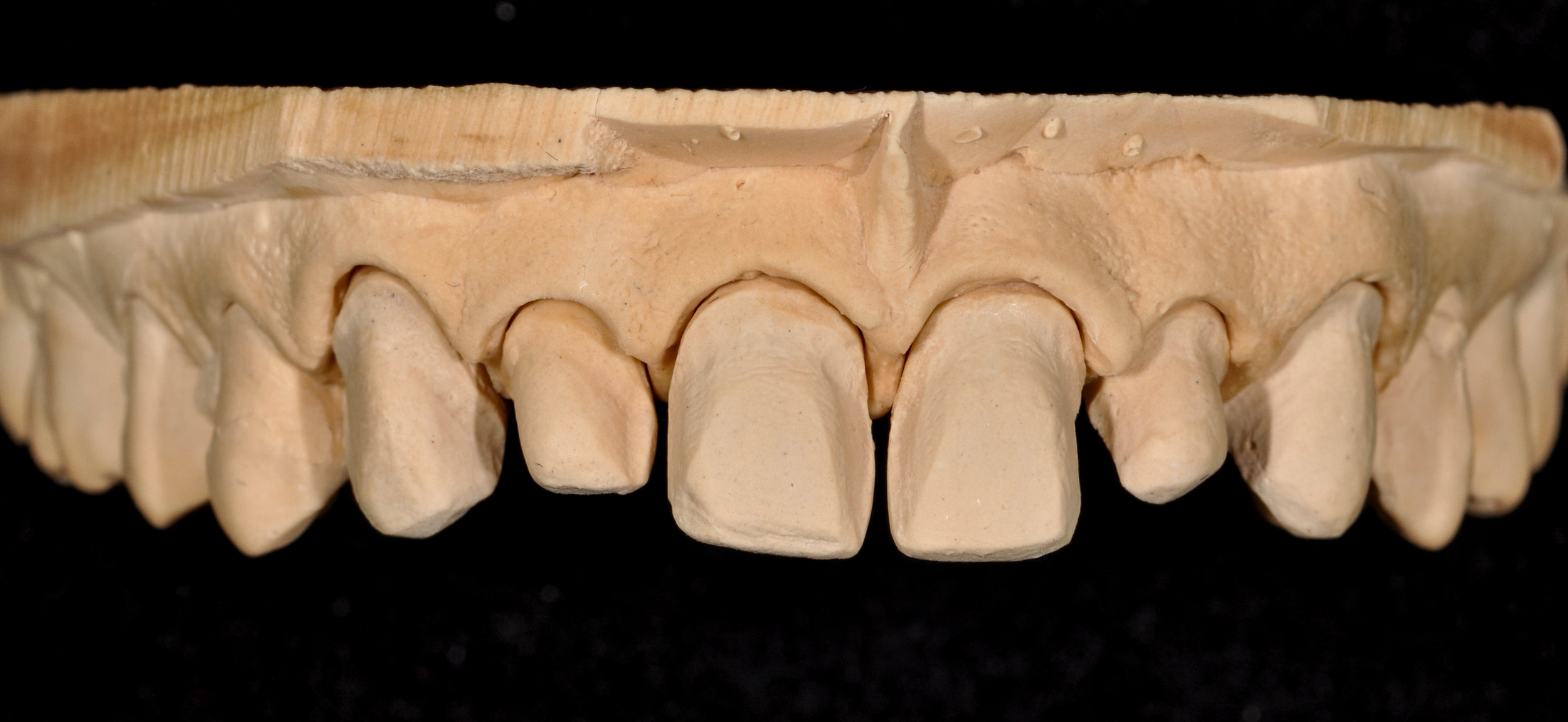 Removable Prosthodontics, Implants, Same Day Model Free Crowns, Full ...