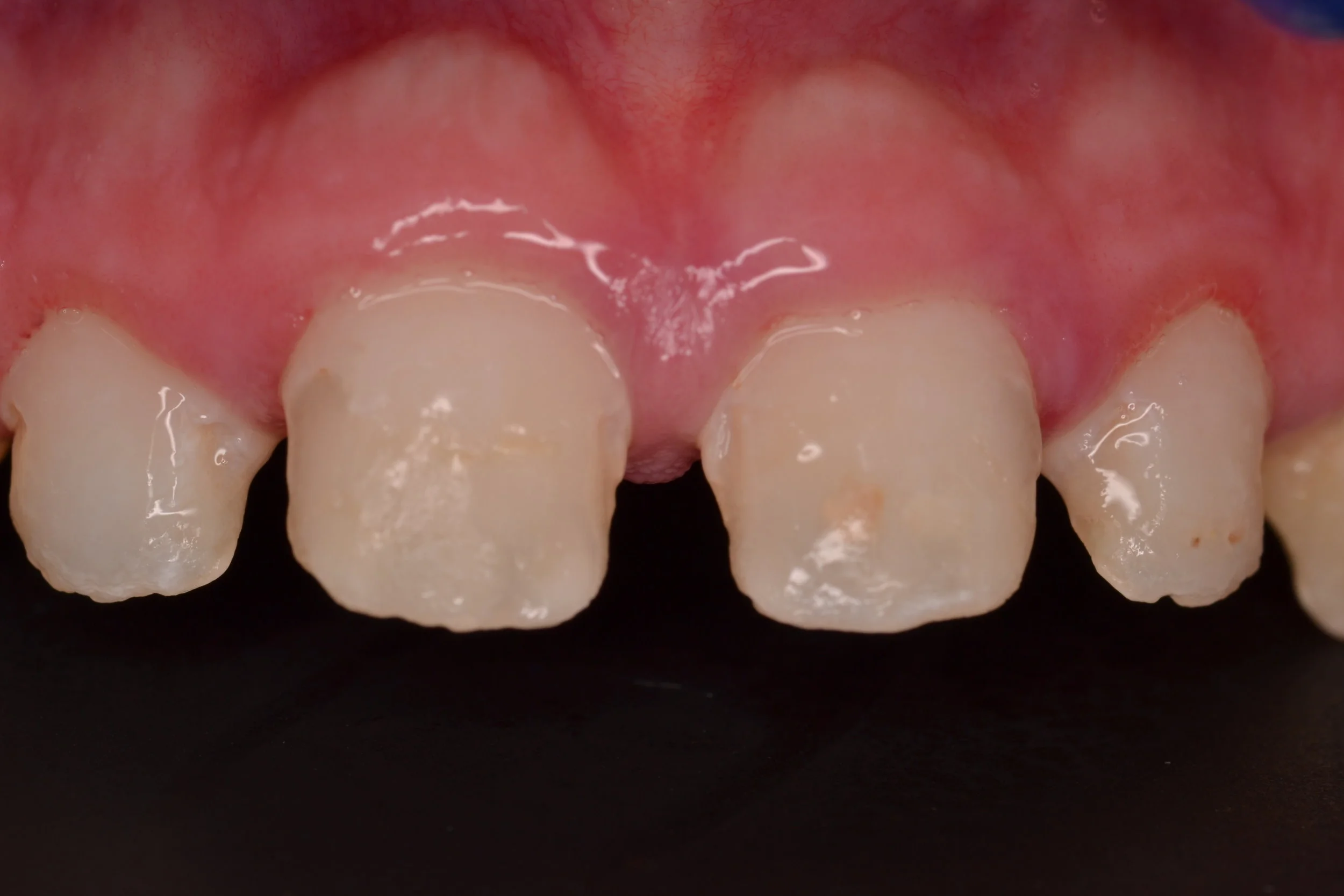 Phasing Complex Treatment for Adolescent Patients with Orthodontic ...