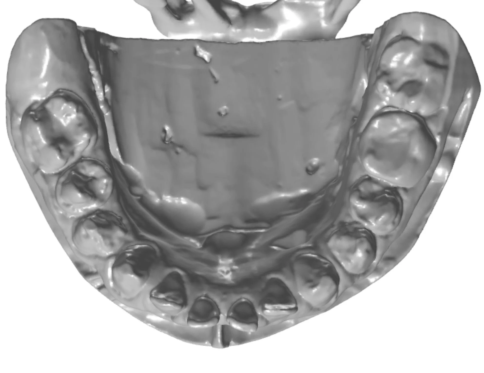 Removable Prosthodontics, Implants, Same Day Model Free Crowns, Full ...