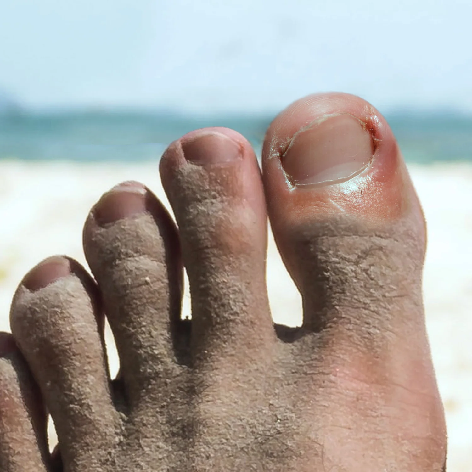 Partial Nail Avulsion Procedure for Ingrown Toenails — BAYSIDE SPORTS ...