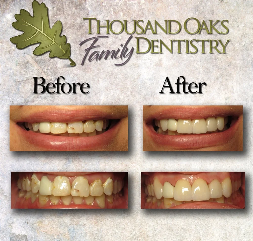 Case Presentation: Special Veneer Restoration