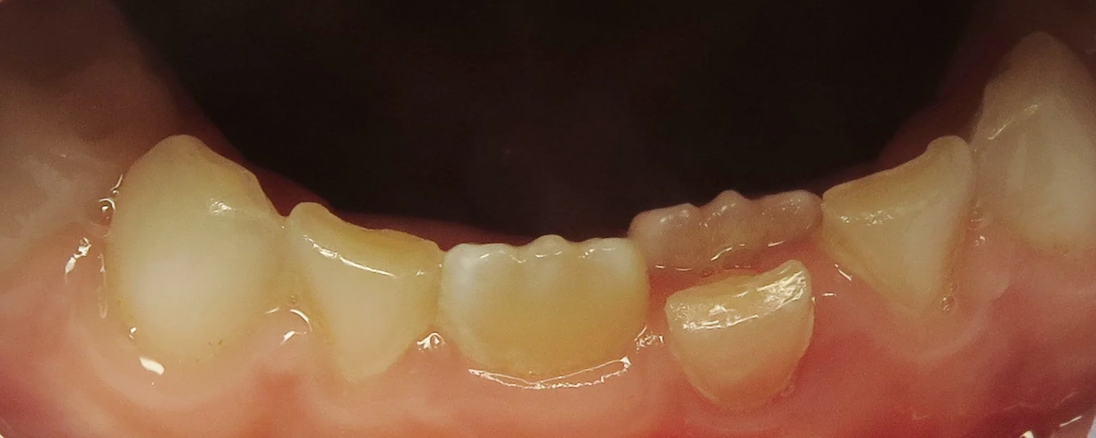 Dental Questions: Are my child's front teeth coming in normally?