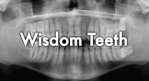 Wisdom Teeth