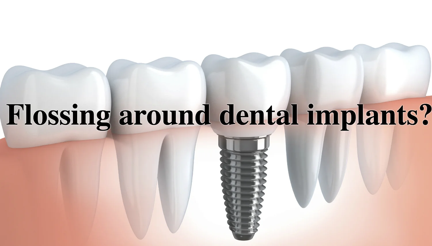 Dental Questions: Flossing around implants