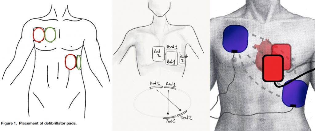 Defibrillation The Pulse Staten Island University Hospital
