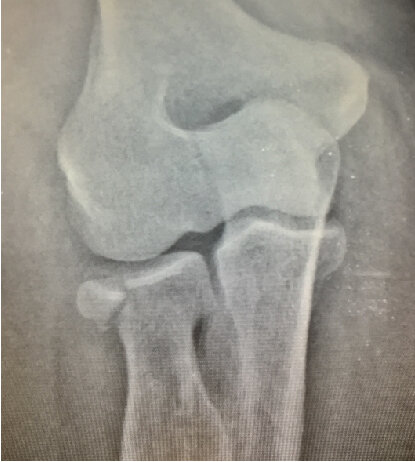 Arthroscopic Radial Head Fracture Fixation(Gallery) — Hunter Medical Inc.