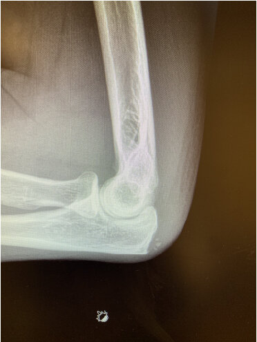 Supine Triceps Allograft Reconstruction — Hunter Medical Inc.