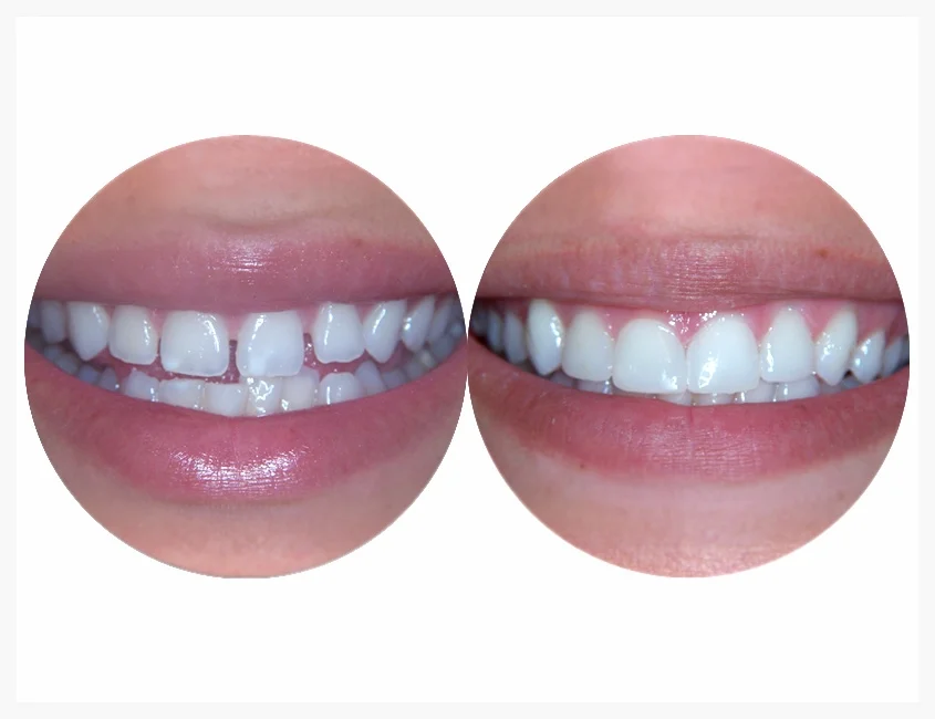 Cosmetic Dental Before and After Photos — Springfield Smile Doctor