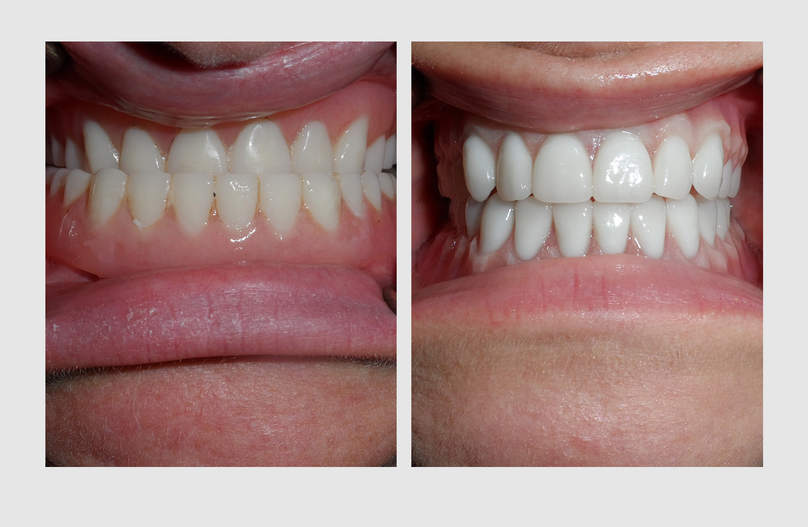 New You Dentures™ Cosmetic Dentures in Springfield, MO — Springfield ... New You Dentures™ Cosmetic Dentures in Springfield, MO — Springfield ...
