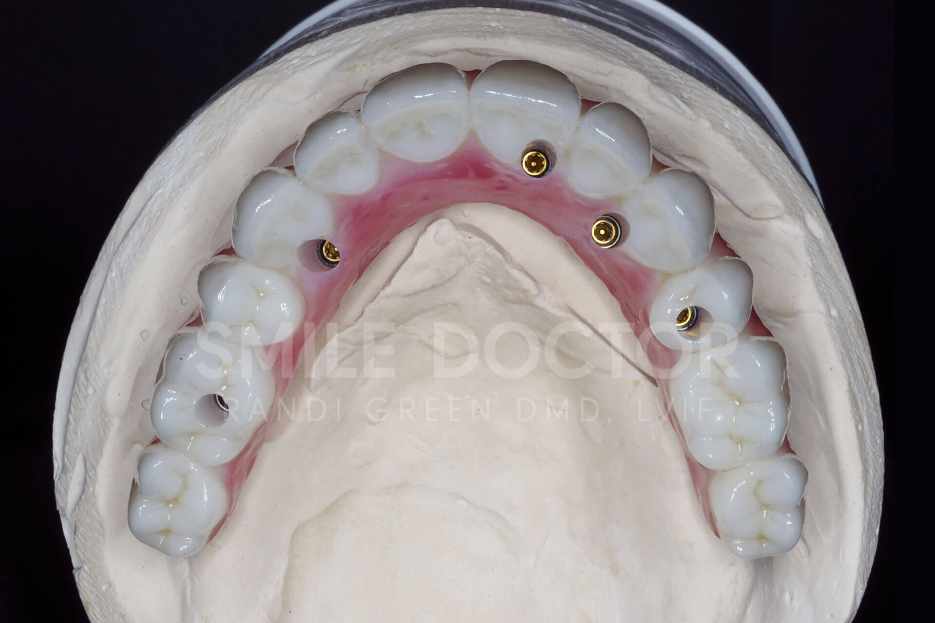 Implant Supported Dentures — Springfield Smile Doctor